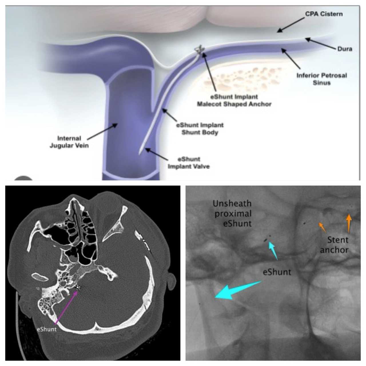 NEUROSURGERY - Reversing Disability with a New Minimally Invasive ...