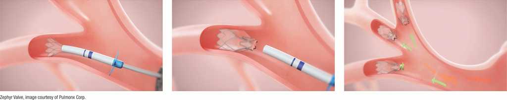 Montefiore Einstein Introduces Groundbreaking Zephyr® Valve ...