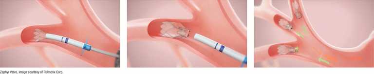 Montefiore Einstein Introduces Groundbreaking Zephyr® Valve ...